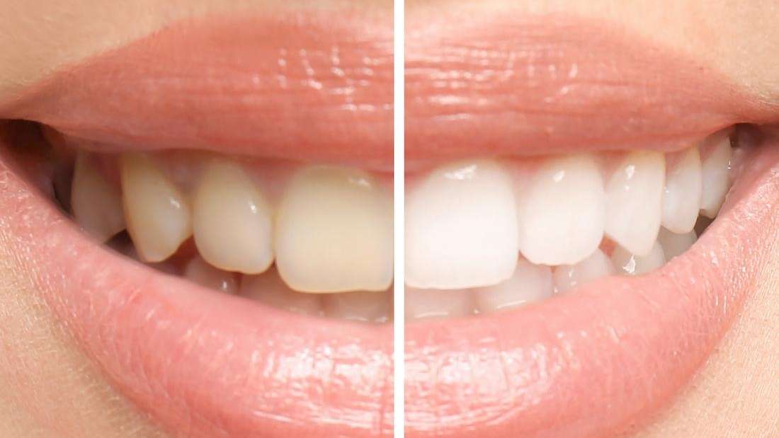Professional vs. Over-the-Counter Teeth Whitening: Which is Right for You?
